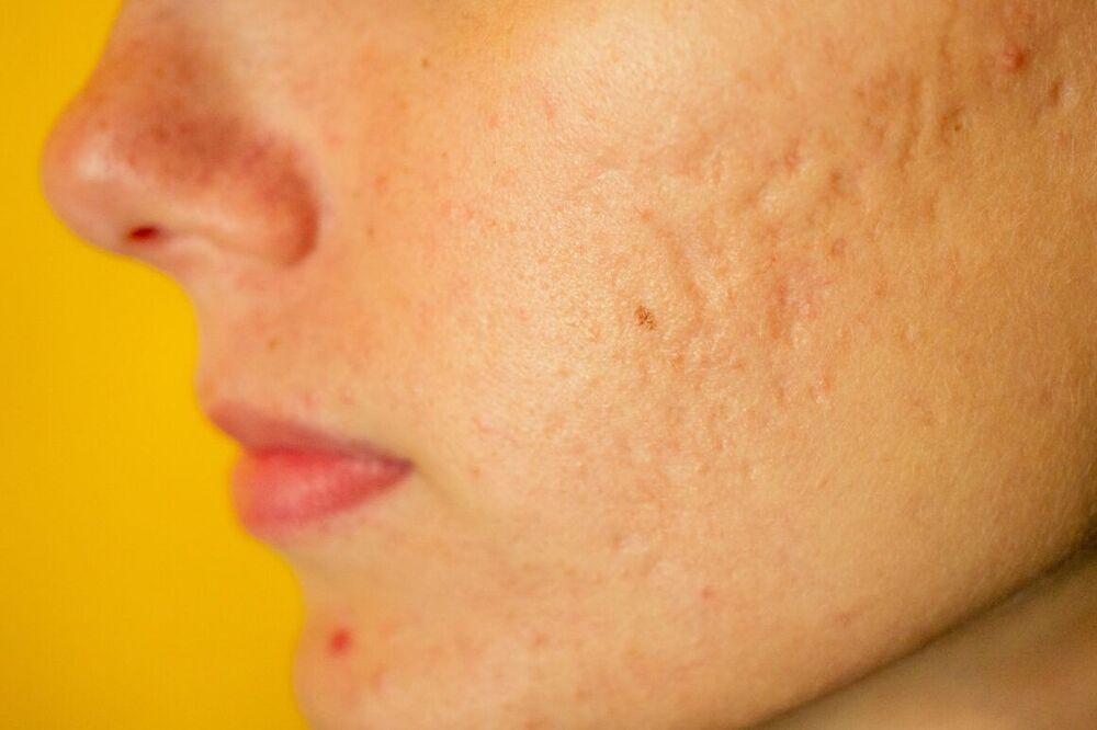How To Treat Post Inflammatory Hyperpigmentation - The Insidexpress