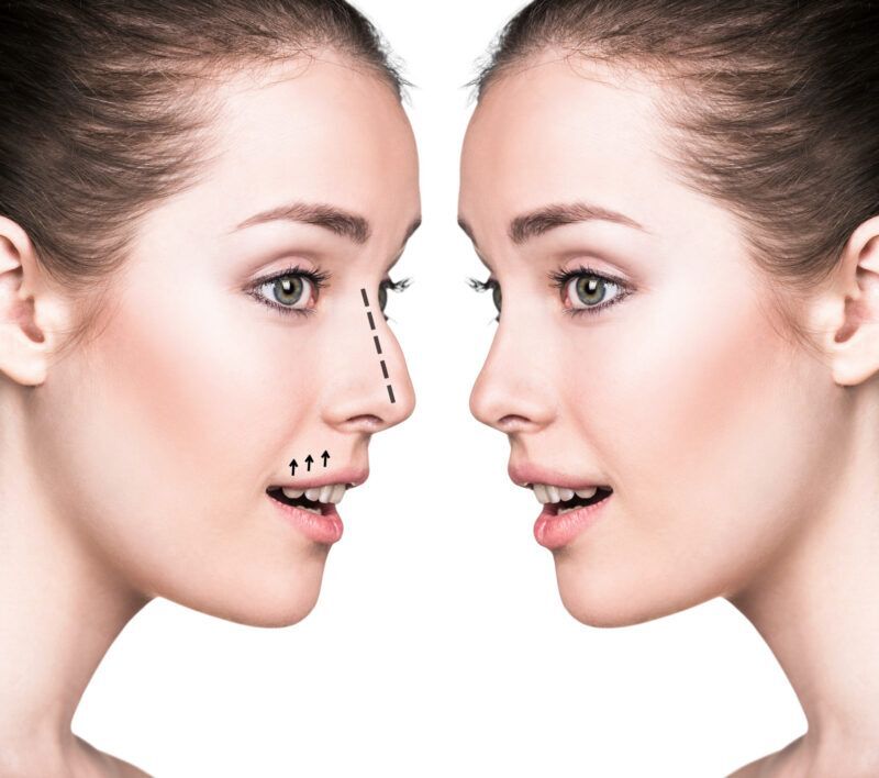 3 Things To Know About Removing A Nose Hump With Rhinoplasty - The ...